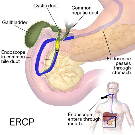 ERCP Integrated Gastroenterology Consultants