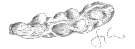 5 Purulent Or Suppurative Exudate Fibrinopurulent Acute Appendicitis