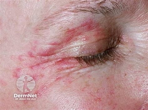 Periocular Dermatitis Periorbital Dermatitis Symptoms With Images