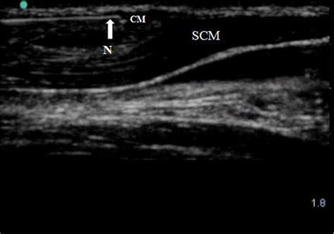 The Ultrasound Guided Anterior Cervical Cutaneous Nerve Block N Download Scientific Diagram