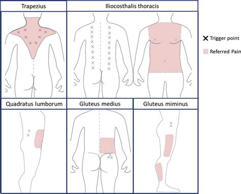 Referred Pain And Trigger Point Location Of Some Common Myofascial Pain