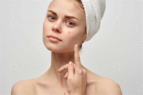 Beautiful Woman With A Pimple On The Face Cosmetology Studio 22003931