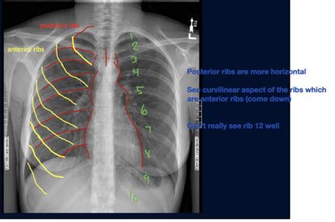 53 Radiology Of The Chest Cxr Flashcards Quizlet 53 Radiology Of The Chest Cxr Flashcards Quizlet