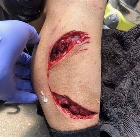Lacerations To The Legs Resulting From A Fall Down A Slide Wpd