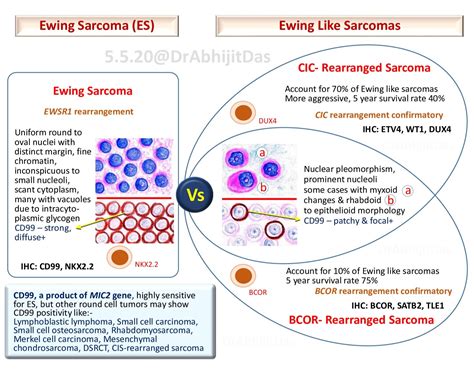Ewings Sarcoma Vs Osteosarcoma