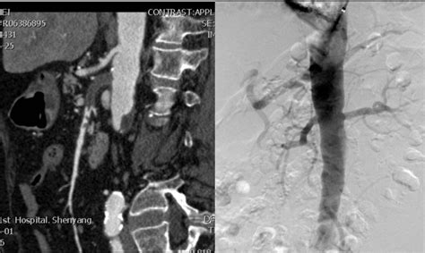 1 Treatment Of Acute Mesenteric Ischemia In An 85 Years Old Man