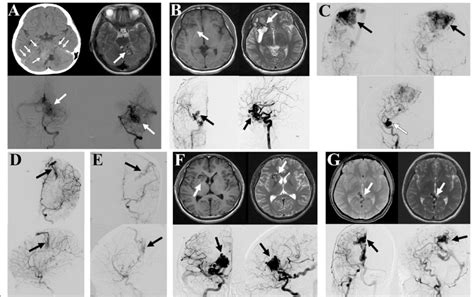 Mri Ct And Dsa Imaging Of Patients Carrying Variants In Syndromic