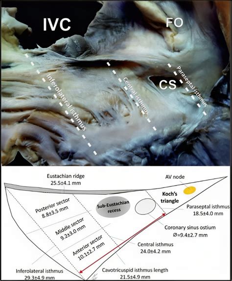 Cavotricuspid Isthmus Dependent Atrial Flutter Beyond Simple Linear Ablation Pmc