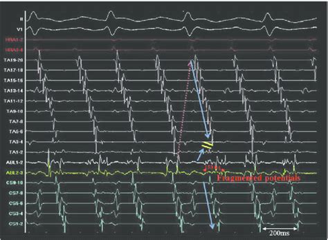 Simultaneous Recordings During Tachycardia In Case 2 From The Surface Download Scientific