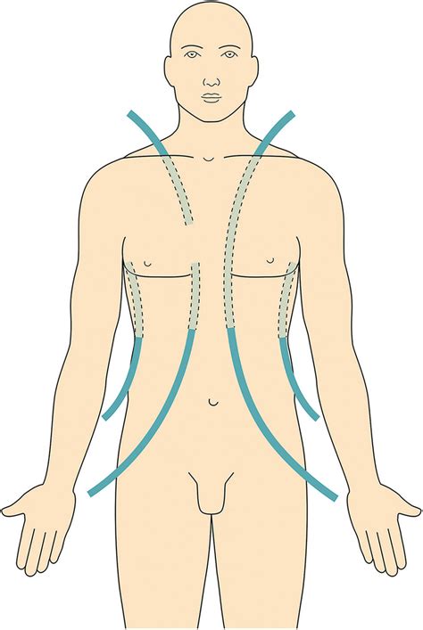 Diagram Of Lavage Drain Of Mediastinum Type Endo Iib Left And Type Download Scientific
