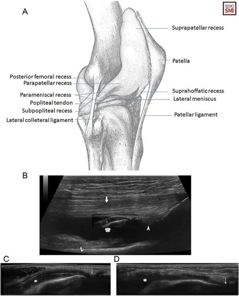 Knee Effusion Wikism Sports Medicine Wiki
