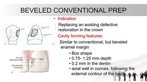 Class Iii Cavity Preparation Pptx