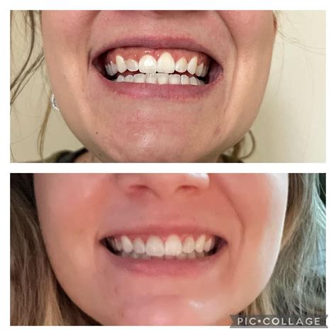 Before And After Gingivectomy Rplasticsurgery
