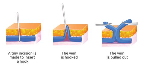 Phlebectomy Clinique Pierre Larose