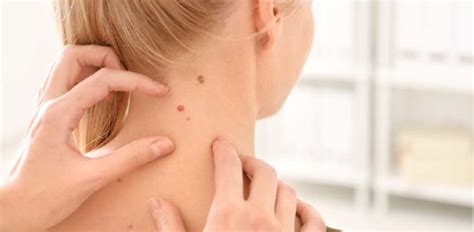 Cancerous Mole Vs Normal Mole