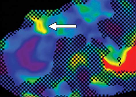 Elastography In Chronic Liver Disease Modalities Techniques Limitations And Future