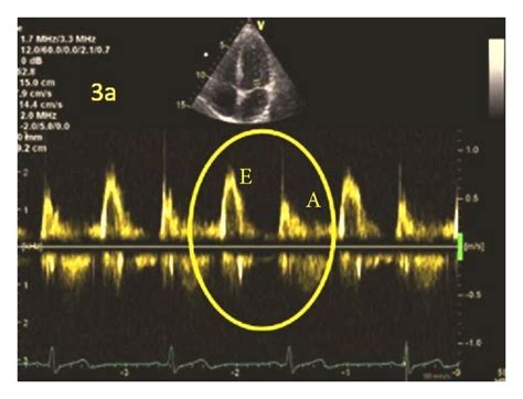 Normal Diastolic Function In Pw Doppler A Or Tdi B On The Lateral Download Scientific