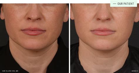 Daxxify Aesthetic Solutions Chapel Hill