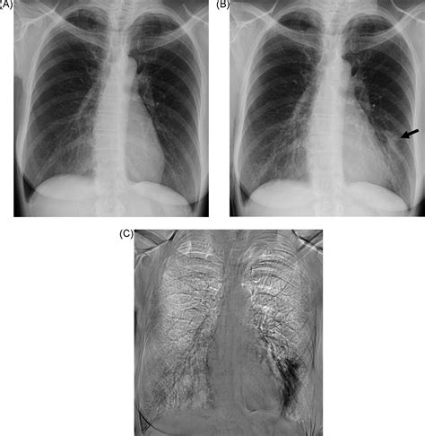 Temporal Subtraction Chest Radiography European Journal Of Radiology
