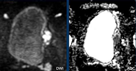 The Radiology Assistant Bladder Cancer Vi Rads