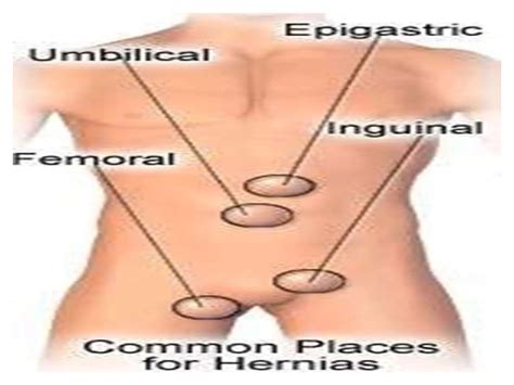 Hernia Classification Of Hernias In Different Forms Ppt