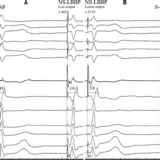 PDF Guidance On Left Bundle Branch Pacing Using Continuous Pacing Technique And Changes In