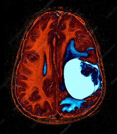 Colour Enhanced Primitive Neuroectodermal Tumour Pnet Mri Stock Image C043 3157 Science