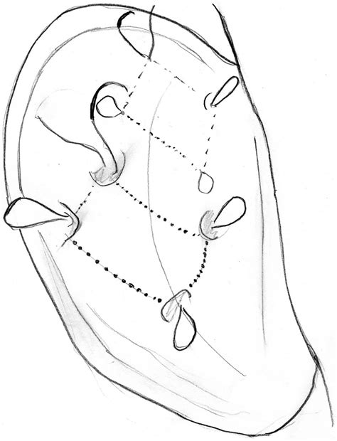 Plastic Surgery Drawing At Explore Collection Of