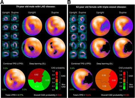 Spect Mpi Deep Learning Analysis Helps Improve Cad Diagnosis Axis