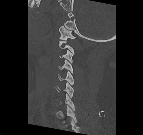 Differential Diagnosis Of Infographic CT Cervical Spine Interpretation