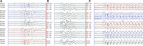 Atypical Epileptiform Discharges Abnormal Morphology A Waves