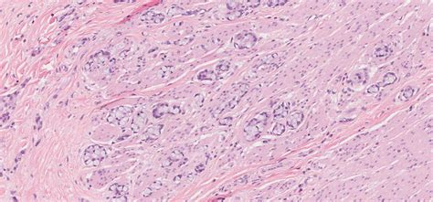 Goblet Cell Adenocarcinoma Of The Appendix Mypathologyreport