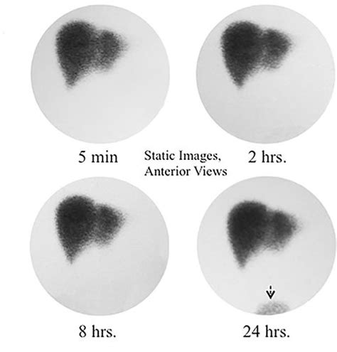Applied Hepatobiliary Scintigraphy In Chronic Gallbladder Diseases Applied Radiology