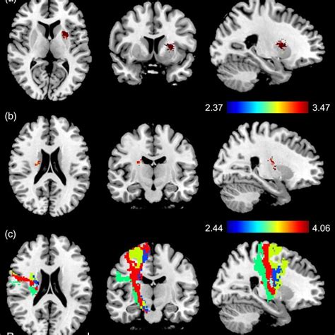 Associations Between Acute Lesion Locations And Chronic Cortical