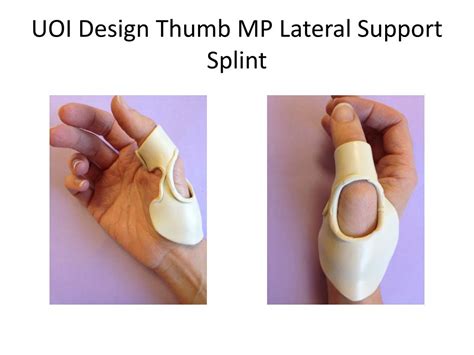Ppt Innovative Splinting Options For The Thumb Mp Joint Powerpoint