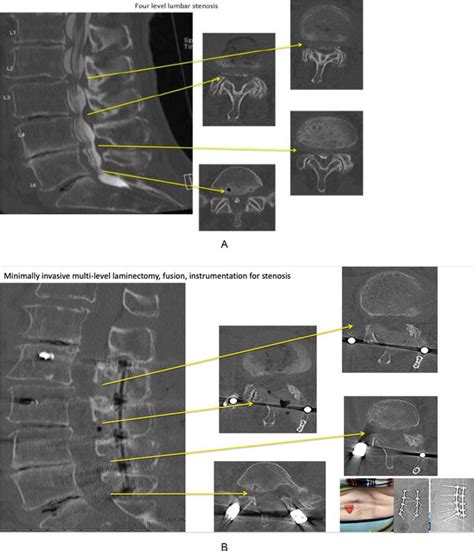 Minimally Invasive Laminectomy For Lumbar Stenosis With Case Series Of