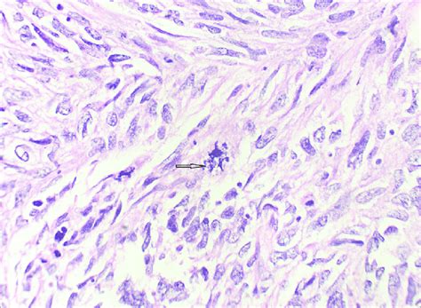H And E Original Magnification ×400 Showing Spindle Shaped Cells