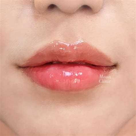 문클리닉 입술필러 리얼후기💋 괜히 싼맛에 아무 곳에서 했다가 뀨가 되거나부작용이 생길까 싶어 입술만큼은 투자하기로 했어요 윗입술이 너무 얇아보여서 고민이셨던