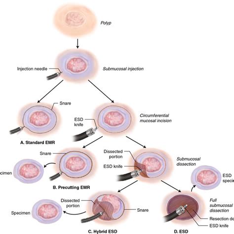 Advanced Endoscopic Resection Techniques Endoscopic Submucosal Dissection And Endoscopic Full