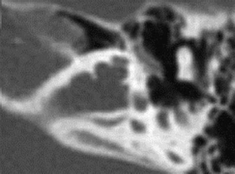 Inner Ear Malformations And Implantation Ento Key