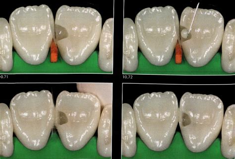 Class Iii Composite Restoration Palatal Access Dental Esthetics