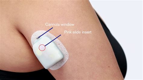 Inserting The Cannula The Omnipod® System Youtube