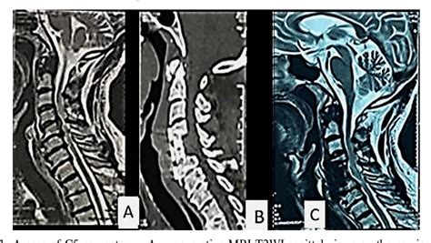 Figure 1 From Cervical Corpectomy Versus Two Level Anterior Discectomy For Double Level Cervical