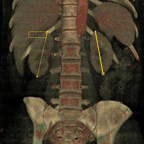 Abbreviation TIBC Total Iron Binding Capacity Figure 1 Abdominal Download Scientific Diagram