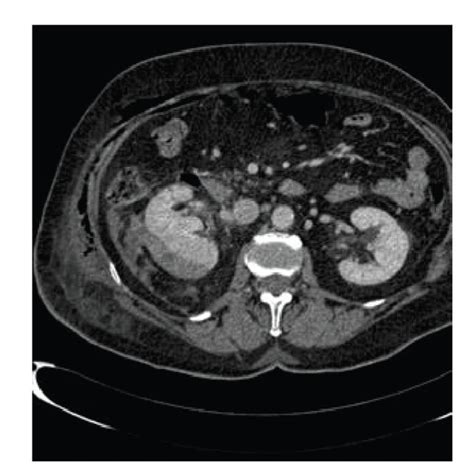 Postoperative Findings After Laparoscopic Left Partial Nephrectomy Download Scientific Diagram