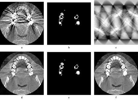 figure 1 from dental ct metal artefact reduction based on sequential