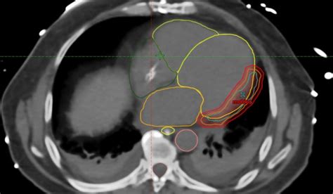 The San Carlos Clinical Hospital Uses Radiotherapy For The Treatment Of