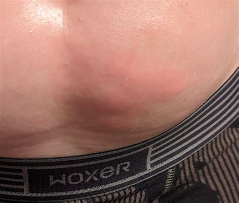 Itching Rash After Testosterone Injection R Medical Advice