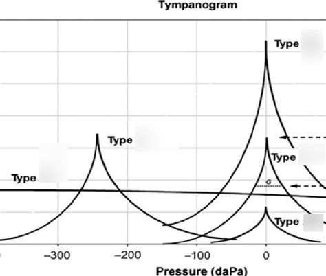 Flat Tympanogram Seen In At Phyllis Bolick Blog
