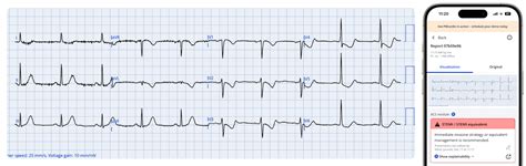 Advanced Stemi Detection And Improved Cath Lab Activation Through Notifications